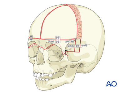 Bilateral orbital advancement for Unilateral coronal synostosis