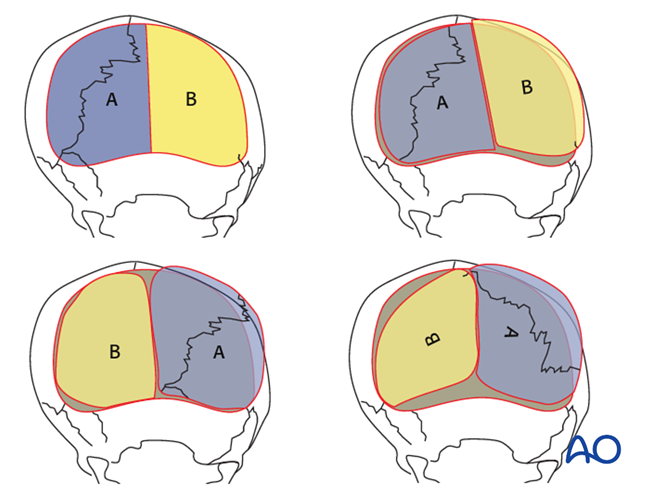 Posterior vault reshaping for Unilateral lambdoid synostosis