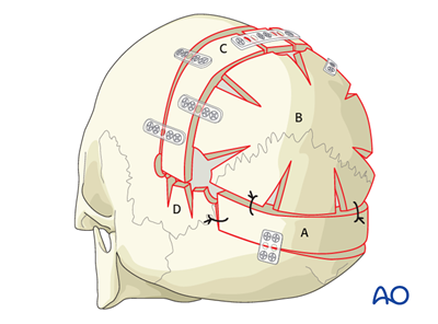 Posterior reshaping for Sagittal synostosis