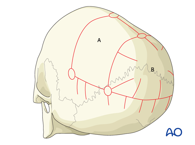 Posterior reshaping for Sagittal synostosis