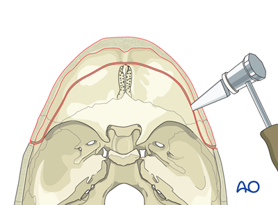 Anterior reshaping with widening for Sagittal synostosis