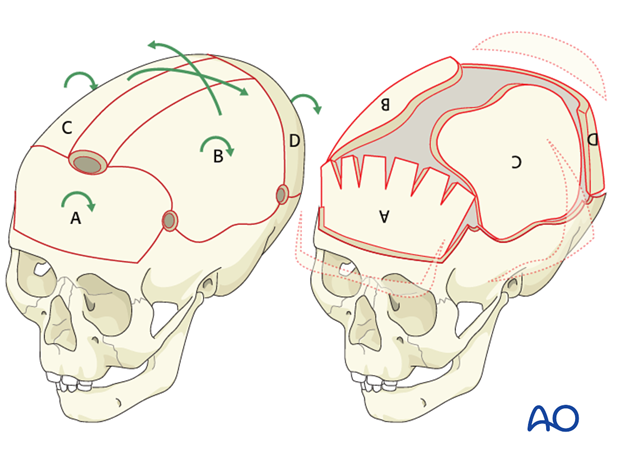 Total vault reshaping for Sagittal synostosis
