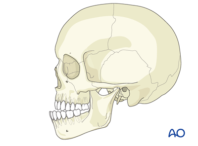 Le Fort III Monoblock - Distraction osteogenesis for Syndromic synostosis