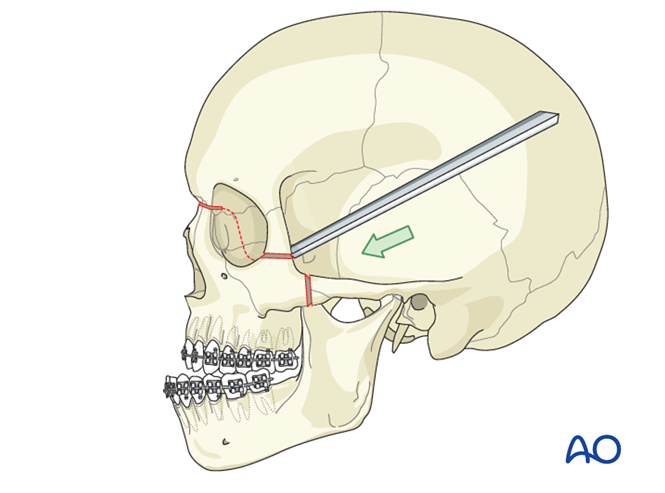 Le Fort III - Conventional for Syndromic synostosis