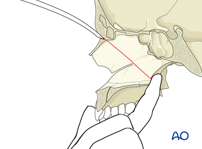 Le Fort III - Conventional for Syndromic synostosis