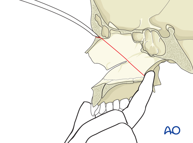 Le Fort III - Conventional for Syndromic synostosis