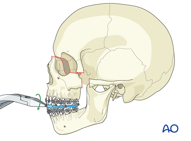 Le Fort III - Conventional for Syndromic synostosis