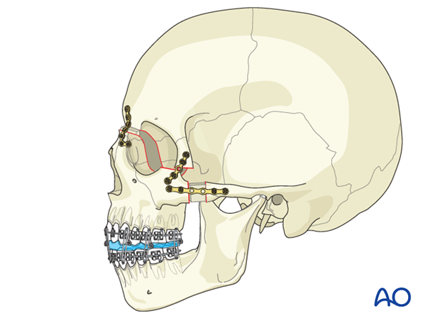 Le Fort III Monoblock - Conventional for Syndromic synostosis