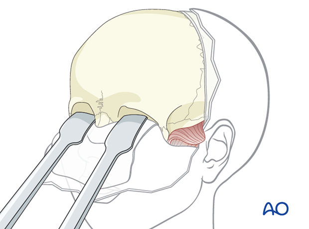 Le Fort III - Conventional for Syndromic synostosis