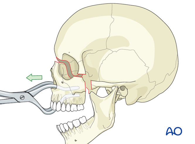 Le Fort III - Distraction osteogenesis for Syndromic synostosis