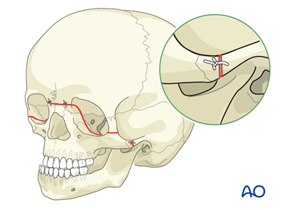 Le Fort III - Distraction osteogenesis for Syndromic synostosis
