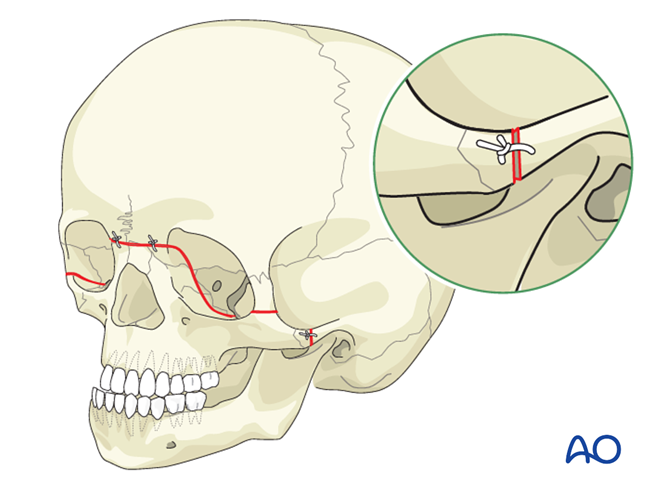 Le Fort III - Distraction osteogenesis for Syndromic synostosis