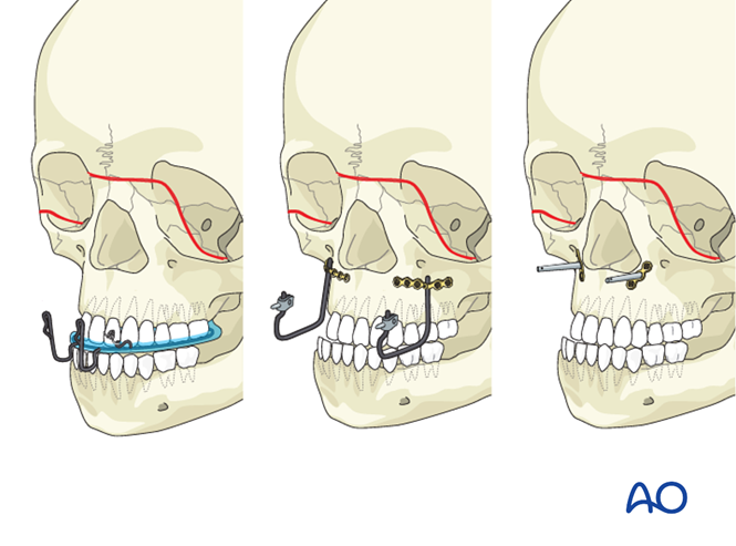Le Fort III - Distraction osteogenesis for Syndromic synostosis