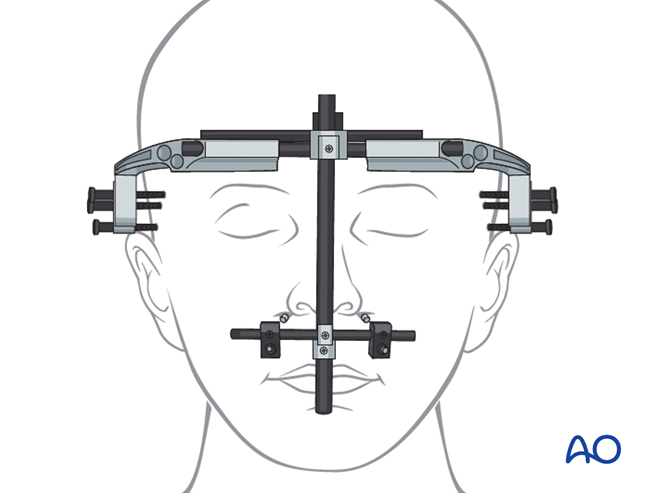 Le Fort III - Distraction osteogenesis for Syndromic synostosis