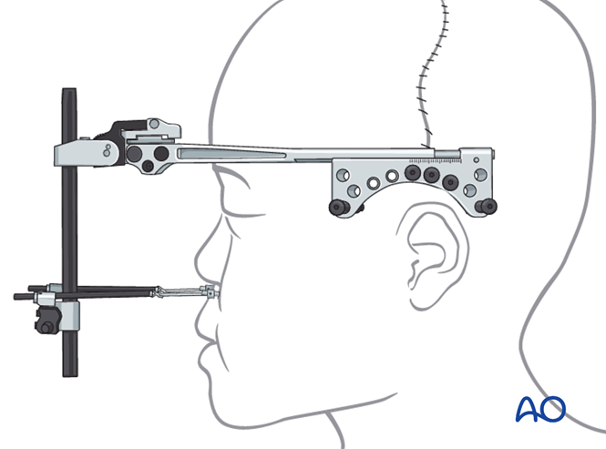 Le Fort III - Distraction osteogenesis for Syndromic synostosis