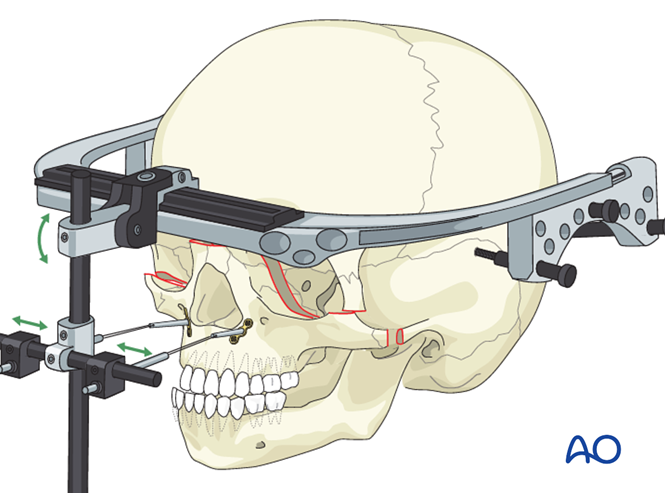 Le Fort III - Distraction osteogenesis for Syndromic synostosis