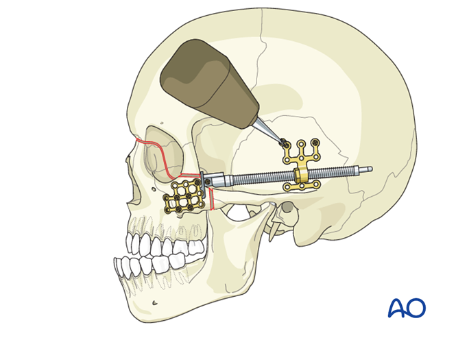 Le Fort III - Distraction osteogenesis for Syndromic synostosis