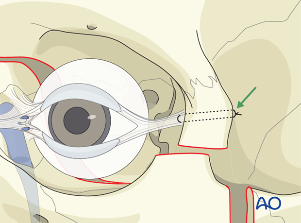 Le Fort III - Distraction osteogenesis for Syndromic synostosis