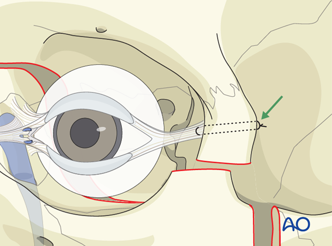 Le Fort III - Distraction osteogenesis for Syndromic synostosis