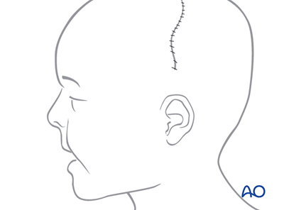 Le Fort III - Distraction osteogenesis for Syndromic synostosis