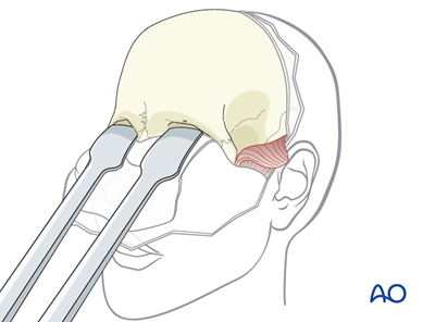Le Fort III Monoblock - Distraction osteogenesis for Syndromic synostosis