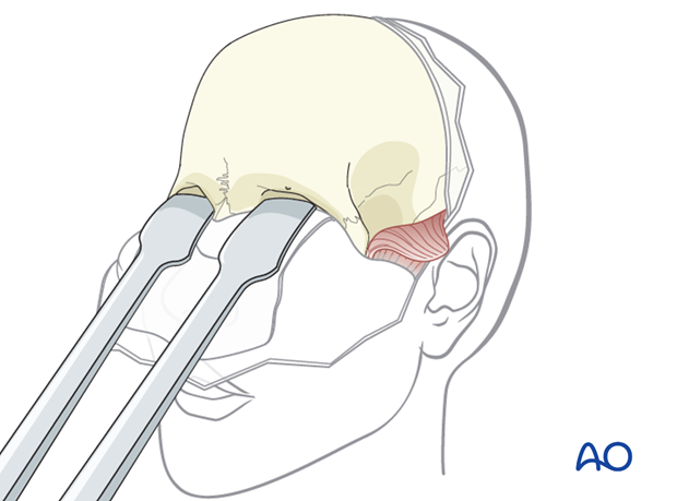 Le Fort III Monoblock - Distraction osteogenesis for Syndromic synostosis