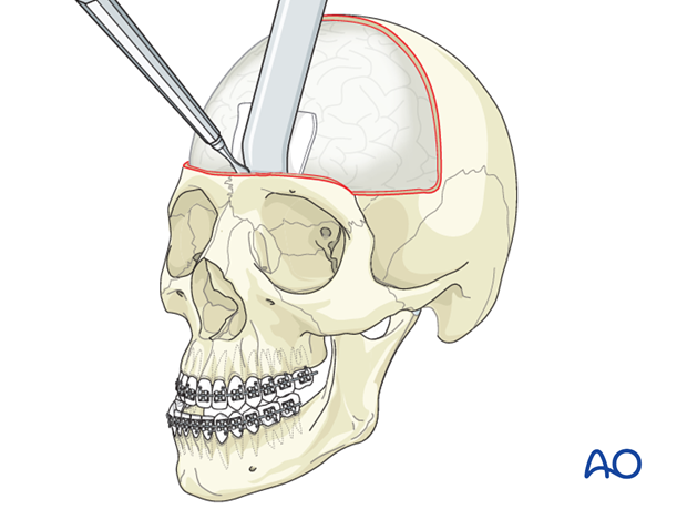Le Fort III Monoblock - Conventional for Syndromic synostosis