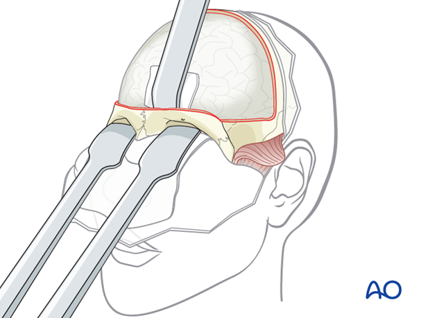 Le Fort III Monoblock - Conventional for Syndromic synostosis