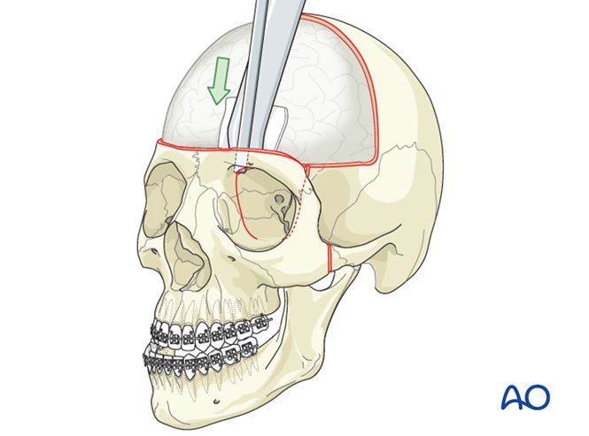 Le Fort III Monoblock - Conventional for Syndromic synostosis