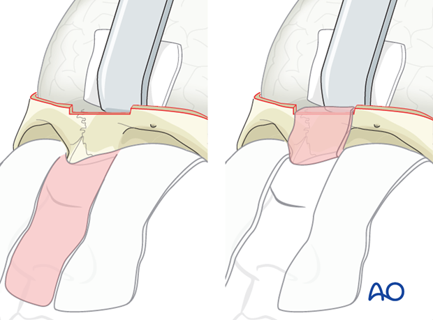 Le Fort III Monoblock - Conventional for Syndromic synostosis