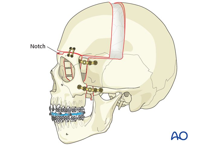 Le Fort III Monoblock - Distraction osteogenesis for Syndromic synostosis