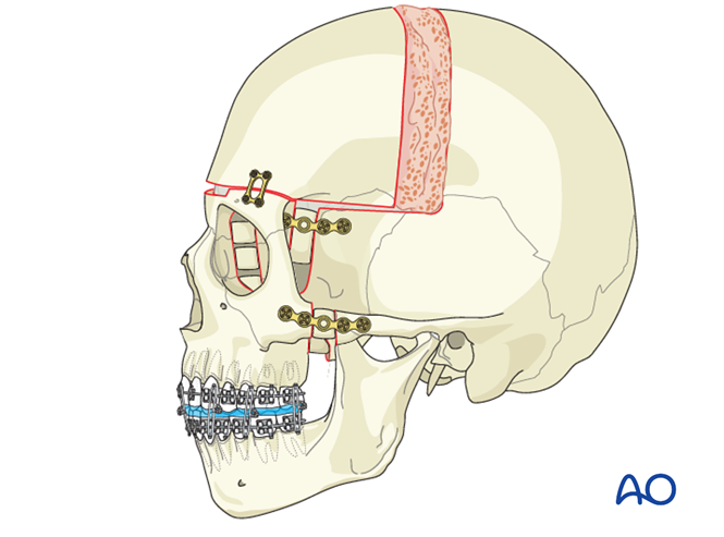 Le Fort III Monoblock - Conventional for Syndromic synostosis
