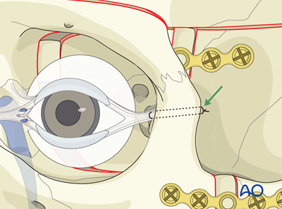 Le Fort III Monoblock - Conventional for Syndromic synostosis