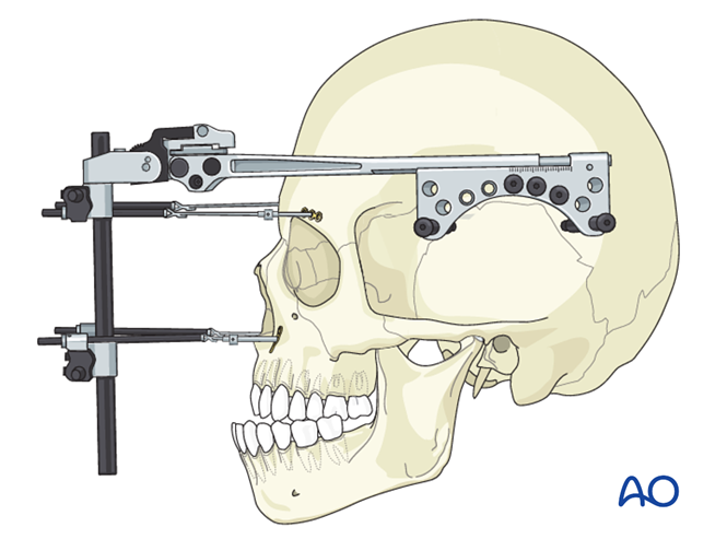 Le Fort III Monoblock - Distraction osteogenesis for Syndromic synostosis