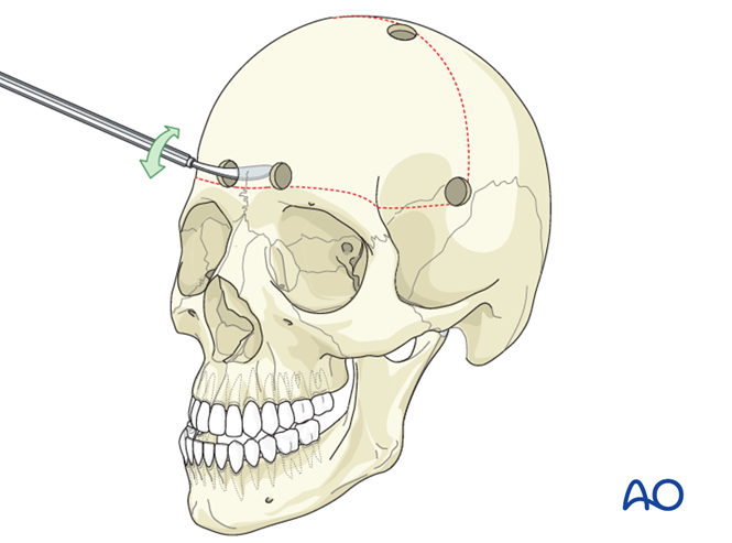 Le Fort III Monoblock - Distraction osteogenesis for Syndromic synostosis