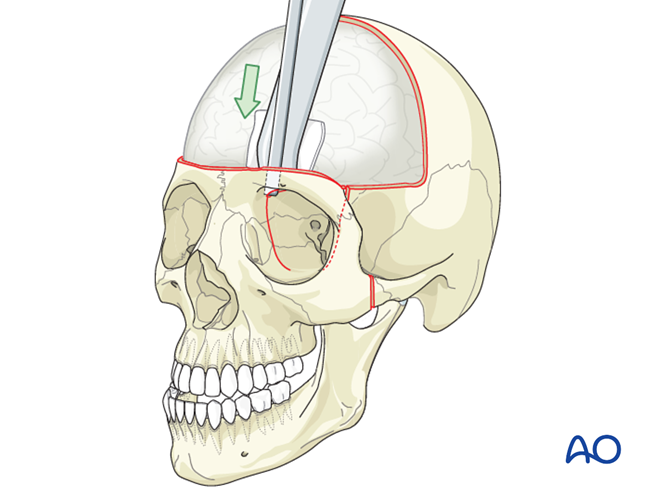 Le Fort III Monoblock - Distraction osteogenesis for Syndromic synostosis