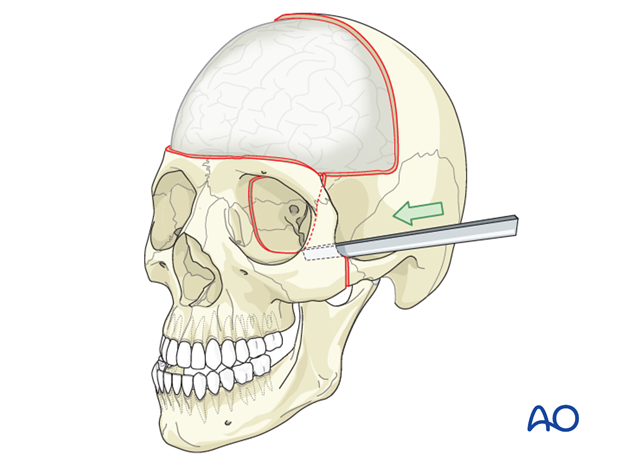 Le Fort III Monoblock - Distraction osteogenesis for Syndromic synostosis