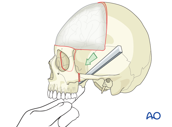 Le Fort III Monoblock - Distraction osteogenesis for Syndromic synostosis