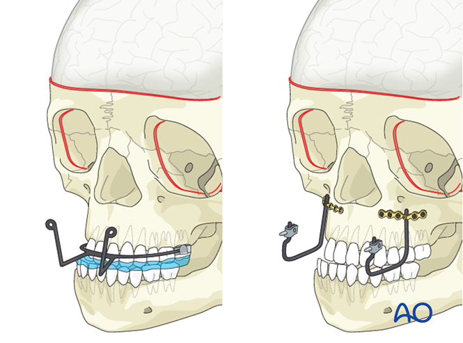 Le Fort III Monoblock - Distraction osteogenesis for Syndromic synostosis