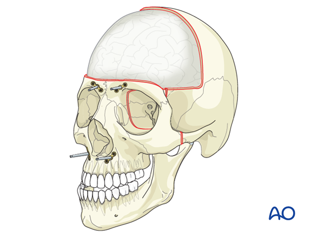 Le Fort III Monoblock - Distraction osteogenesis for Syndromic synostosis