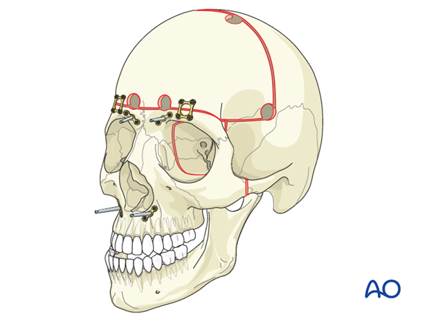 Le Fort III Monoblock - Distraction osteogenesis for Syndromic synostosis