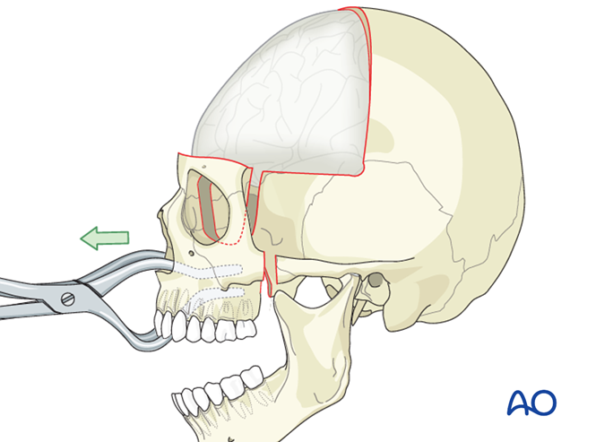 Le Fort III Monoblock - Distraction osteogenesis for Syndromic synostosis
