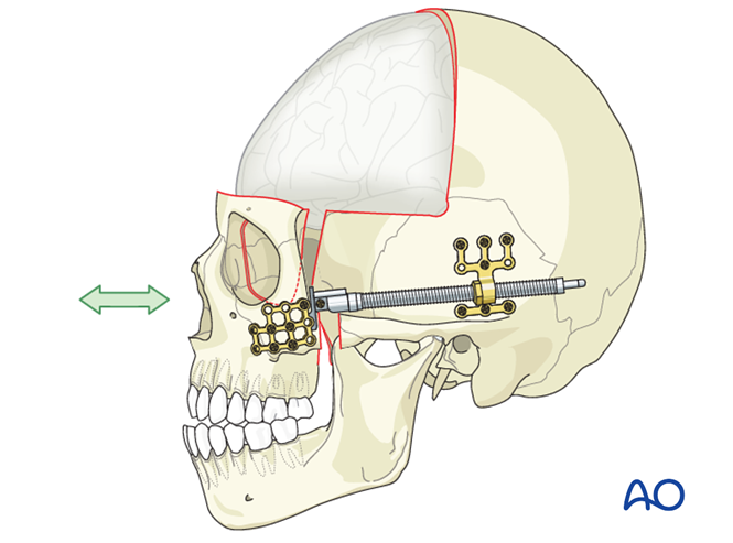 Le Fort III Monoblock - Distraction osteogenesis for Syndromic synostosis