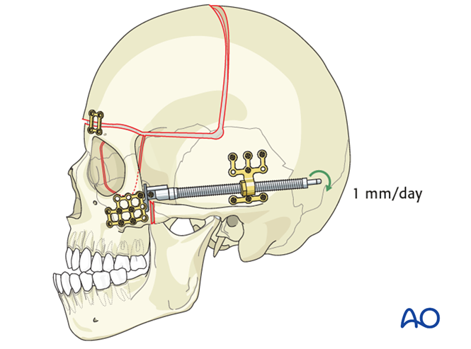 Le Fort III Monoblock - Distraction osteogenesis for Syndromic synostosis