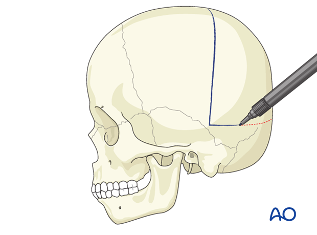 Posterior vault expansion by distraction osteogenesis for Syndromic ...
