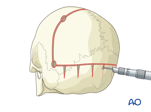 Posterior vault expansion by distraction osteogenesis for Syndromic ...