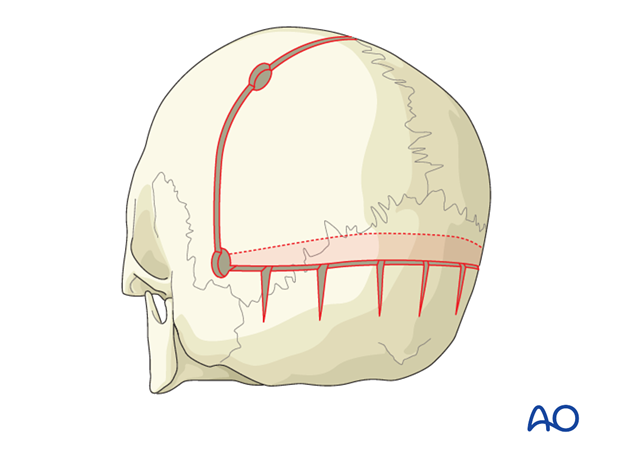 Posterior Calvarial Distraction