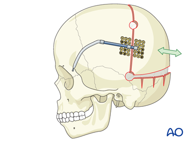 Posterior vault expansion by distraction osteogenesis for Syndromic ...