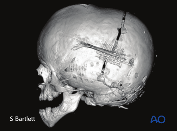Posterior vault expansion by distraction osteogenesis for Syndromic ...