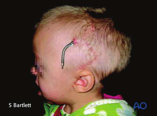 Posterior Calvarial Distraction